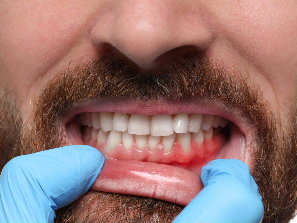 Zwaar ontstoken tandvlees: zo herken je het en behandeling - ANT ...